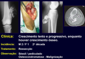 Osteocondroma - Oncocirugia