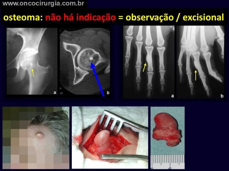 Diagnóstico de las lesiones óseas - Oncocirugia