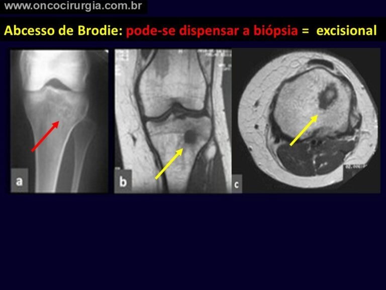 Diagnóstico de las lesiones óseas - Oncocirugia